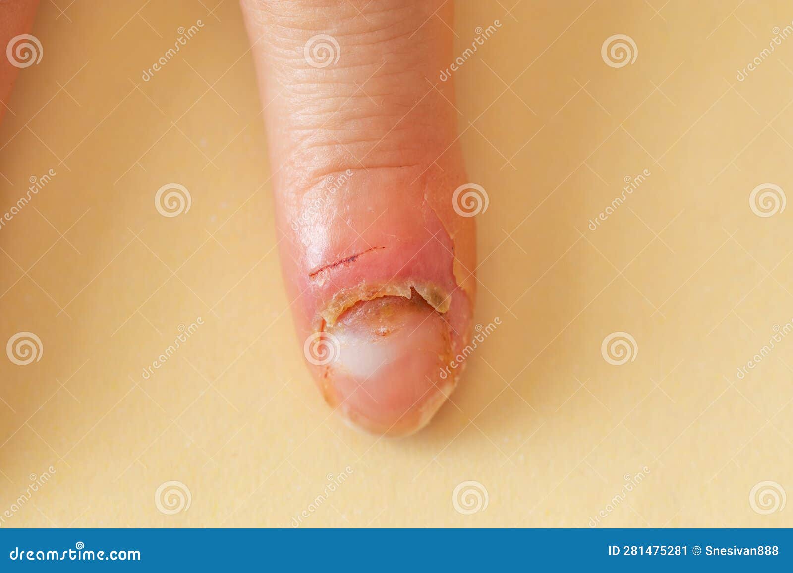 Inflammation of the Finger. Managing Finger Inflammation. Stock Image ...