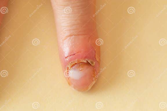 Inflammation of the Finger. Managing Finger Inflammation. Stock Image ...