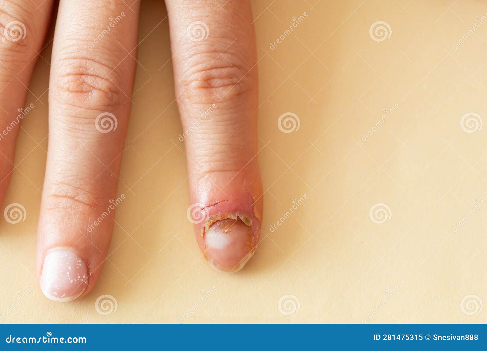 Inflammation of the Finger. Managing Finger Inflammation. Stock Image ...