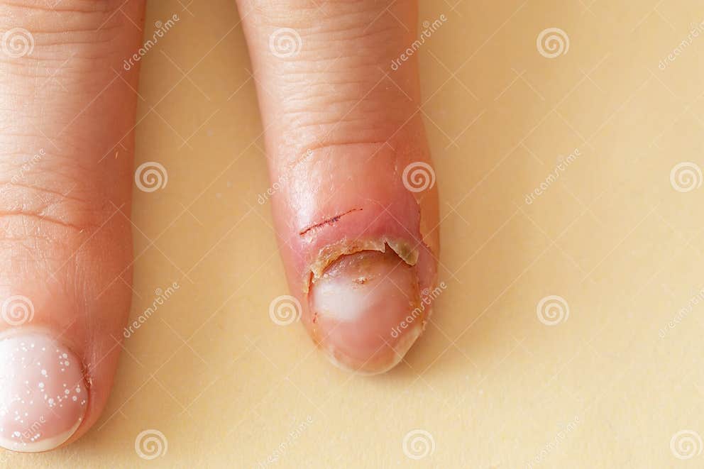 Inflammation of the Finger. Managing Finger Inflammation. Stock Image ...