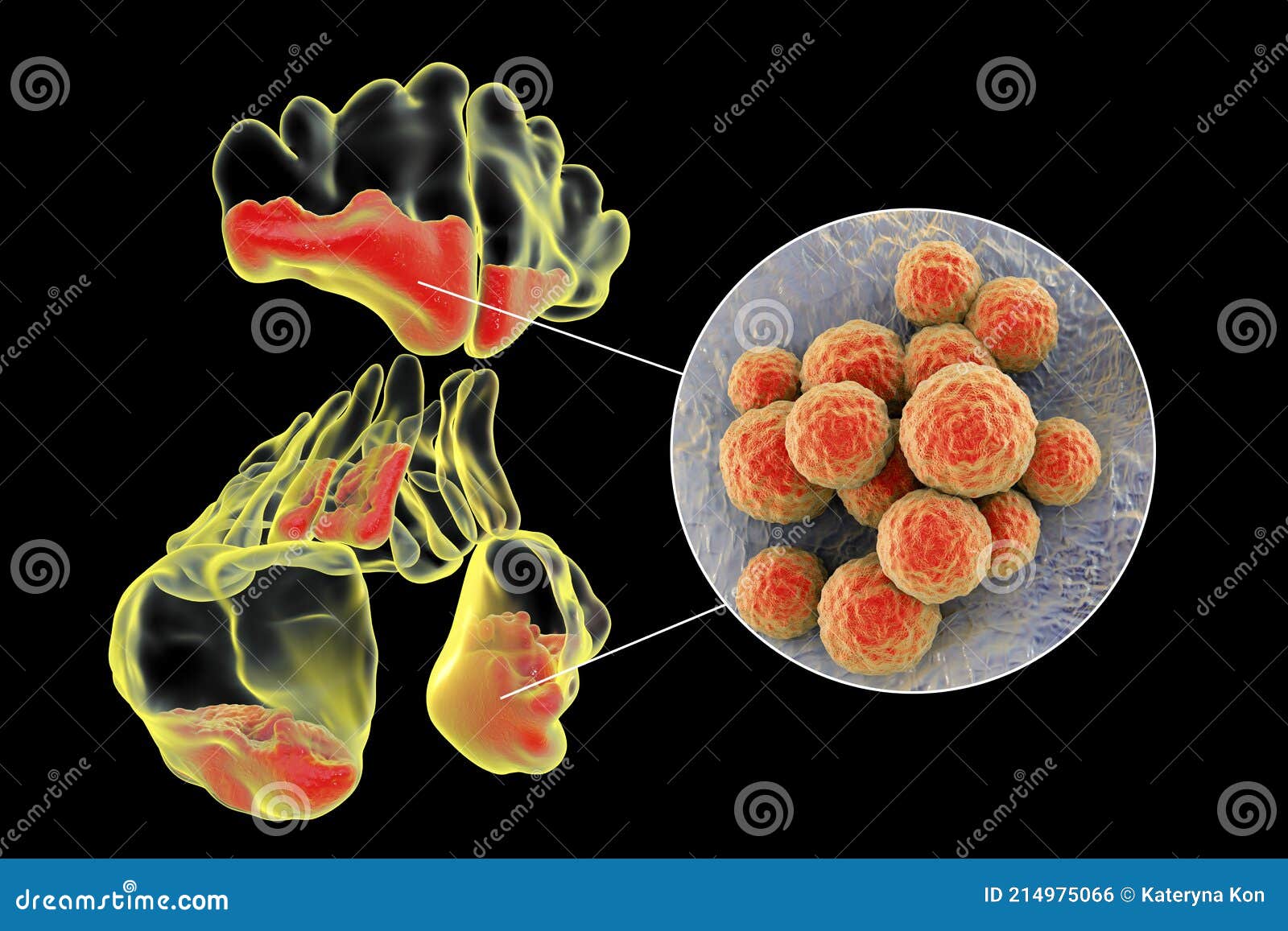 Inflammation of Frontal, Maxillary, and Ethmoid Sinuses and Close-up ...