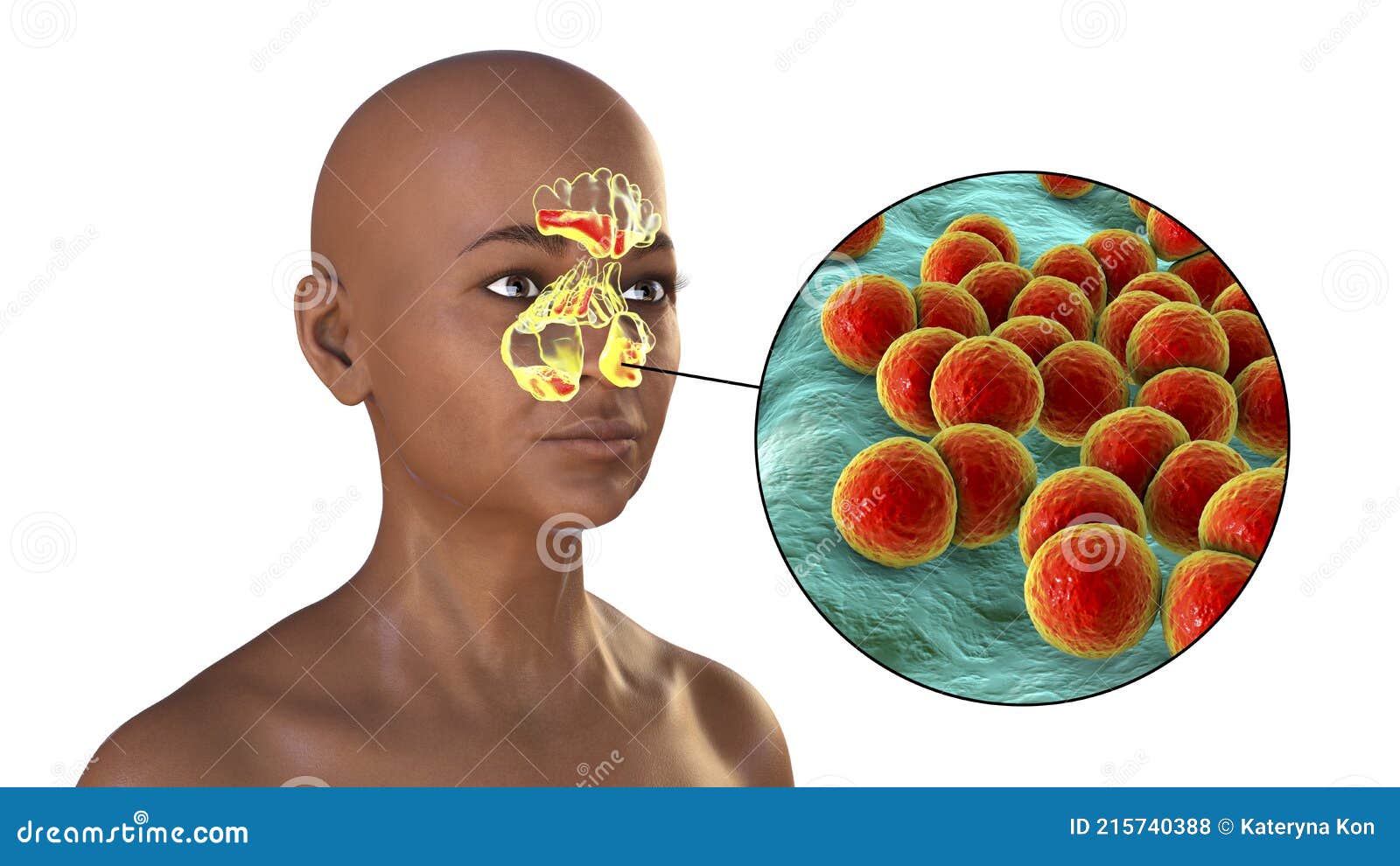 Inflammation of Frontal and Maxillary Sinuses and Close-up View of ...