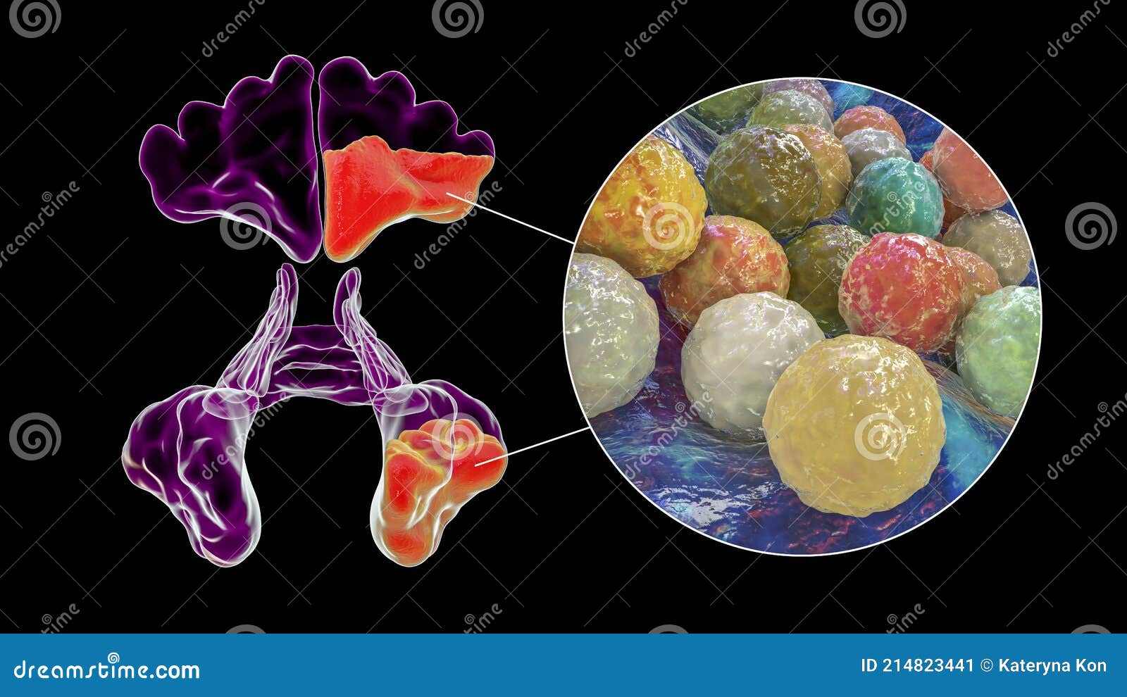 Inflammation of Frontal and Maxillary Sinuses and Close-up View of ...