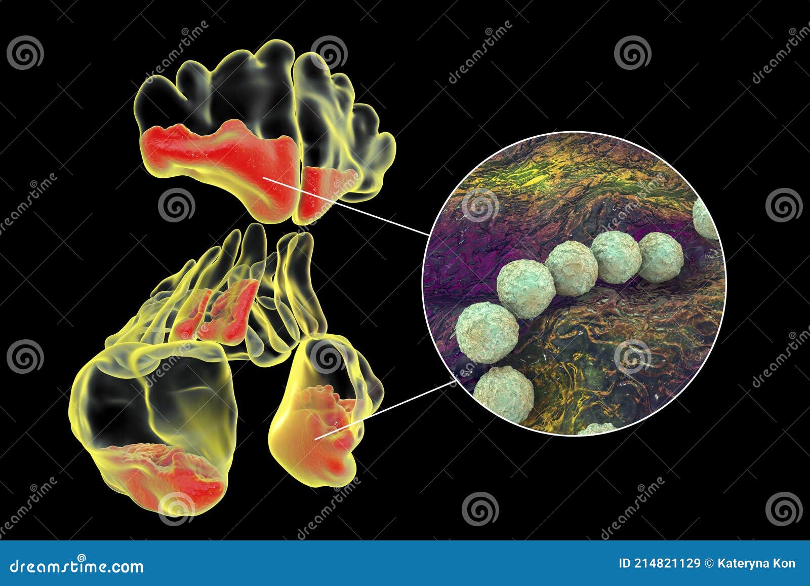 Inflammation of Frontal and Maxillary Sinuses and Close-up View of ...