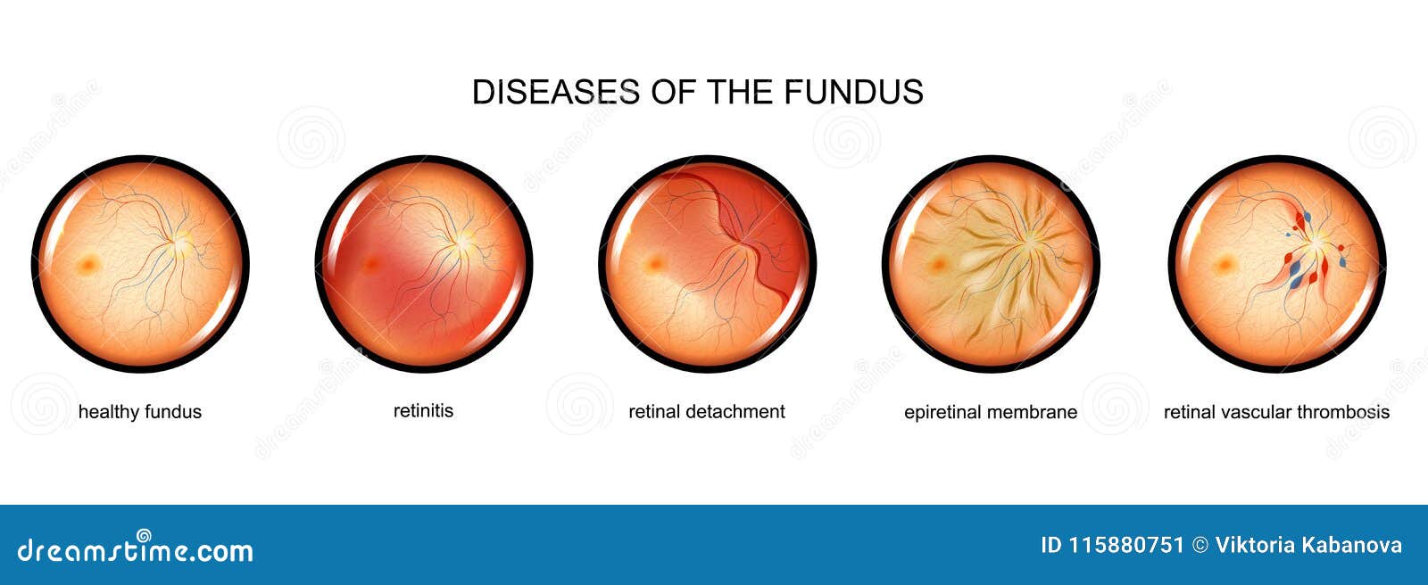 Fundus. Retinal Vascular Thrombosis Vector Illustration | CartoonDealer ...