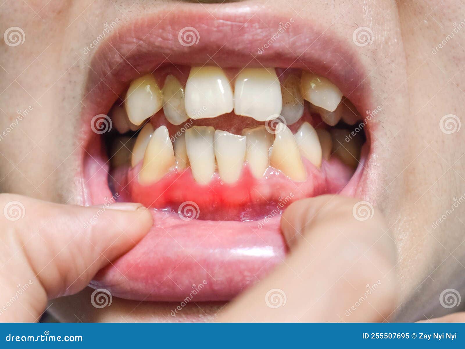 Inflammation of Gum Called Gingivitis. Periodontal Problem Stock Image ...