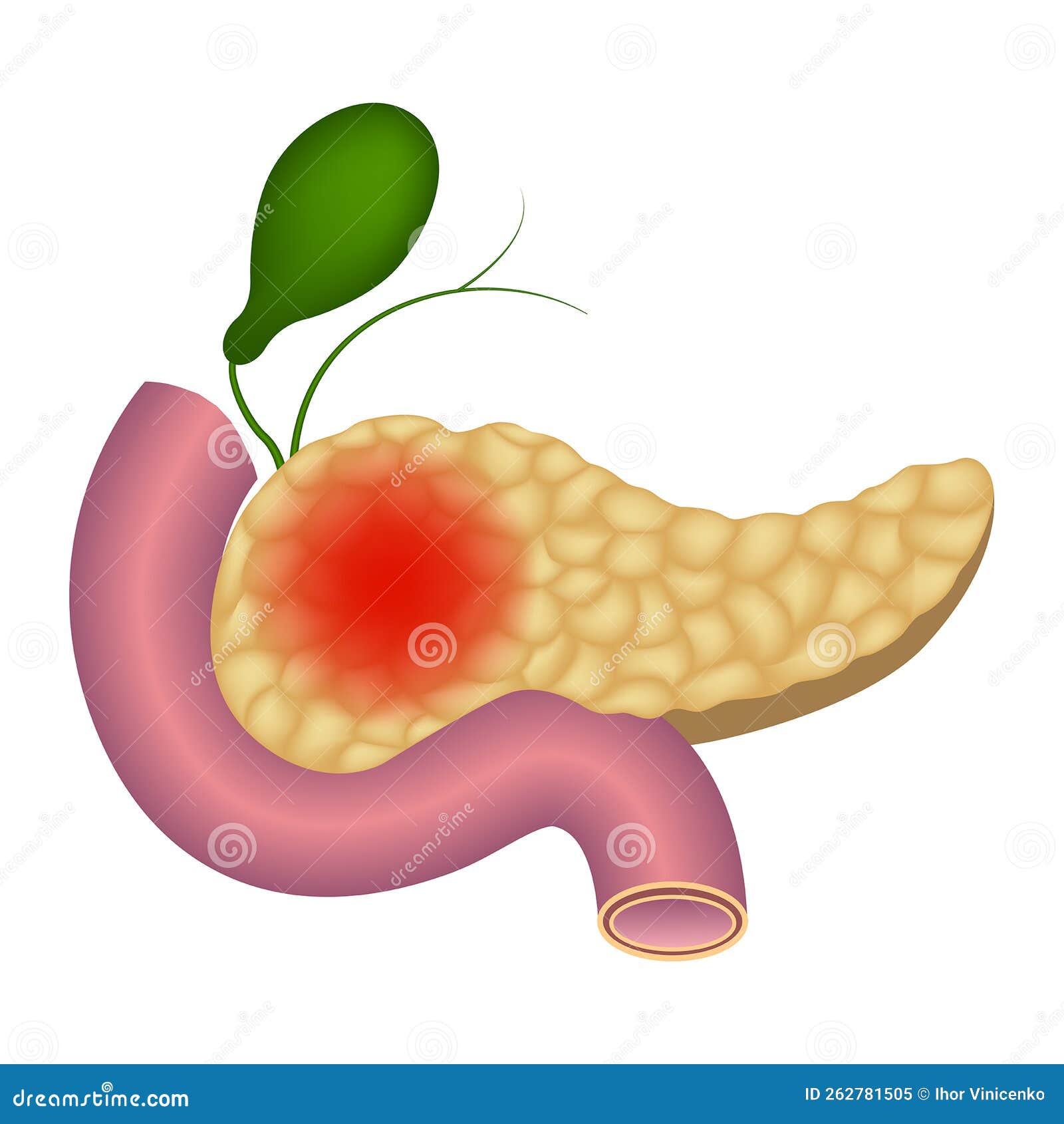 Inflammation Of The Pancreas. Pancreatitis. The Vector Illustration ...