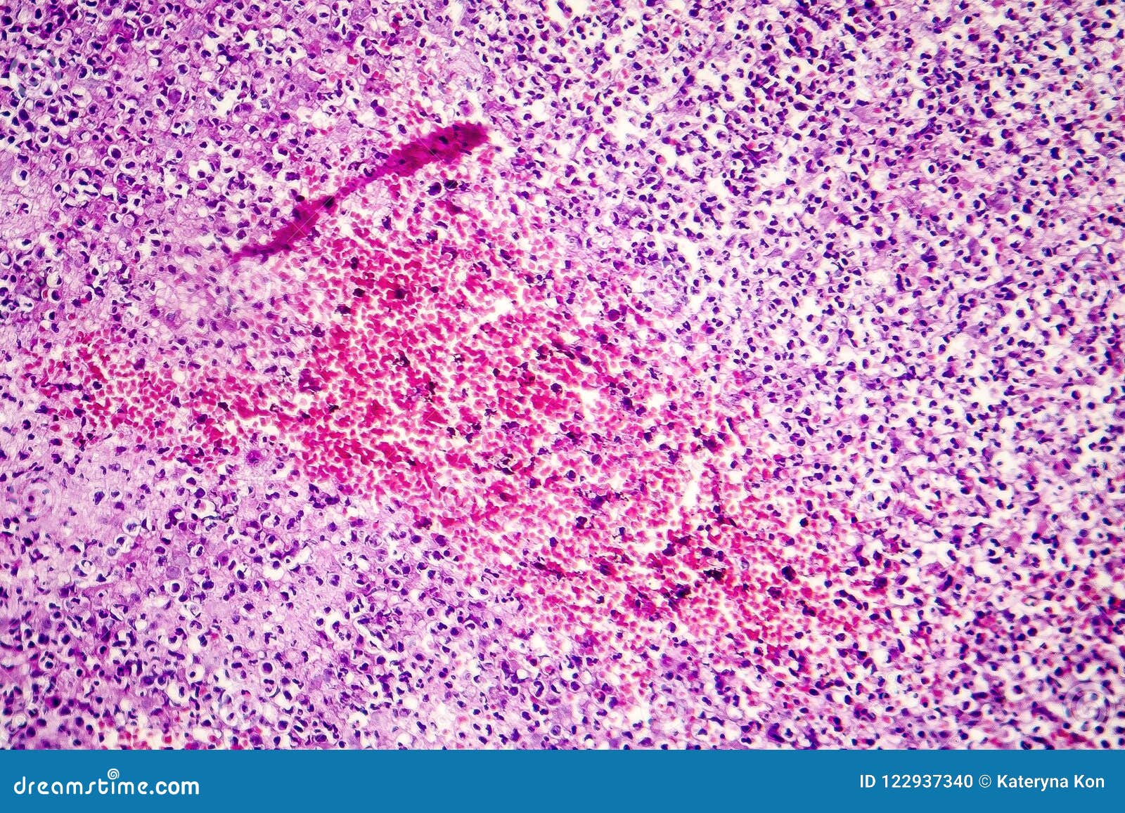 Inflammation Microscope Stock Photos - Royalty Free Images