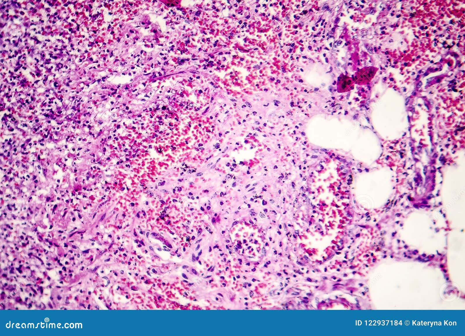 Inflammation, Light Micrograph Showing Different Inflammatory Cells ...