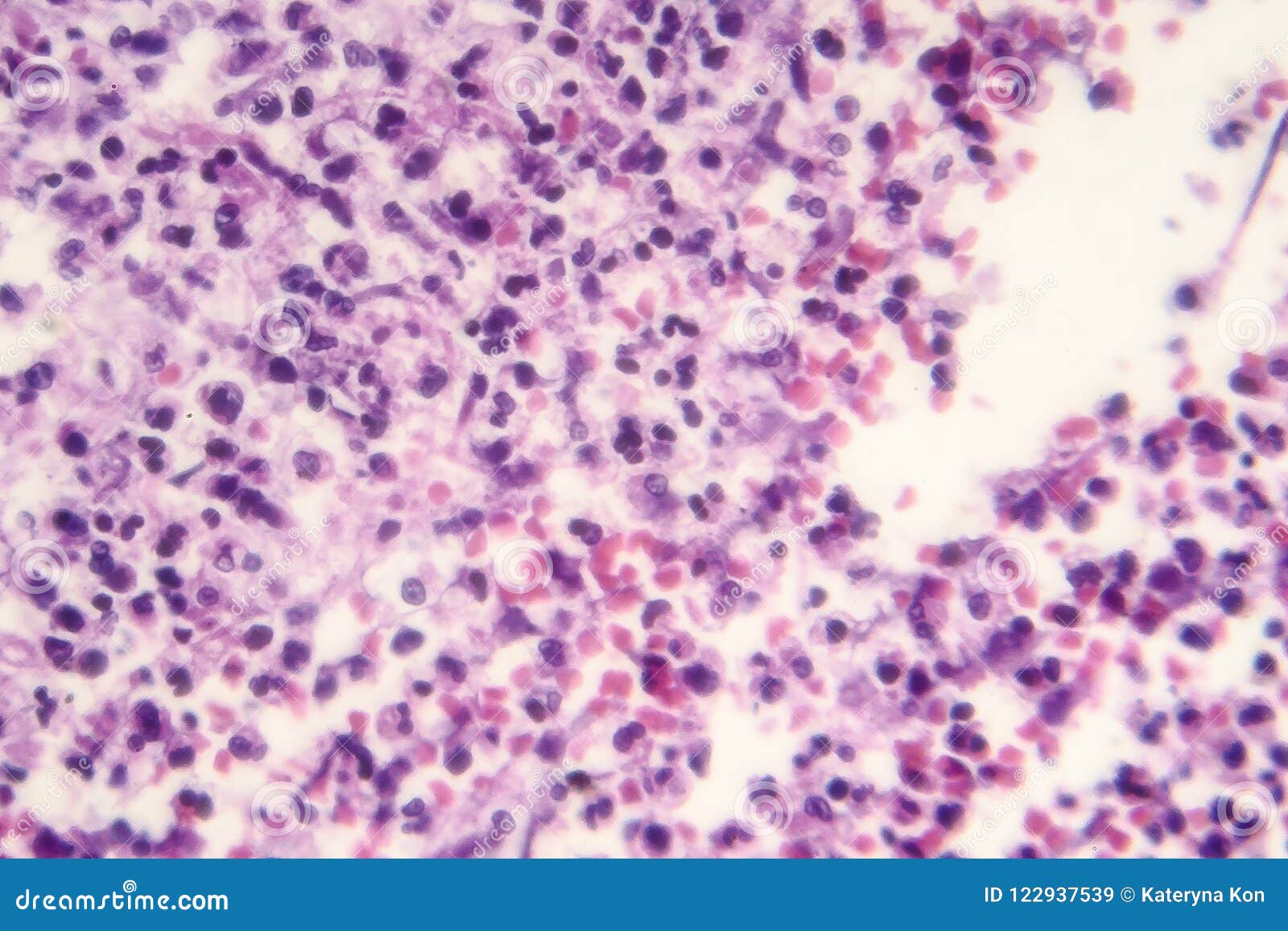 Inflammation, Light Micrograph Showing Different Inflammatory Cells ...