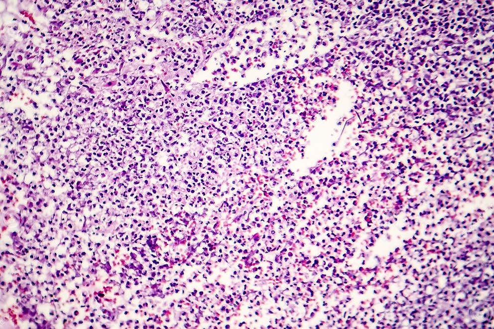 Inflammation, Light Micrograph Showing Different Inflammatory Cells ...