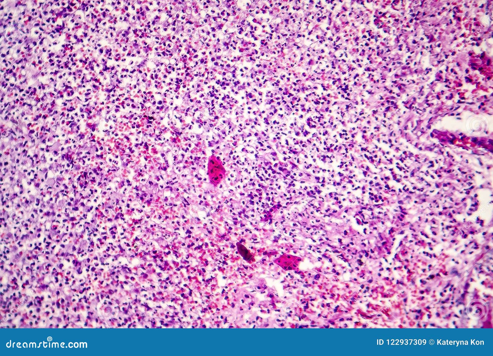 Inflammation, Light Micrograph Showing Different Inflammatory Cells ...