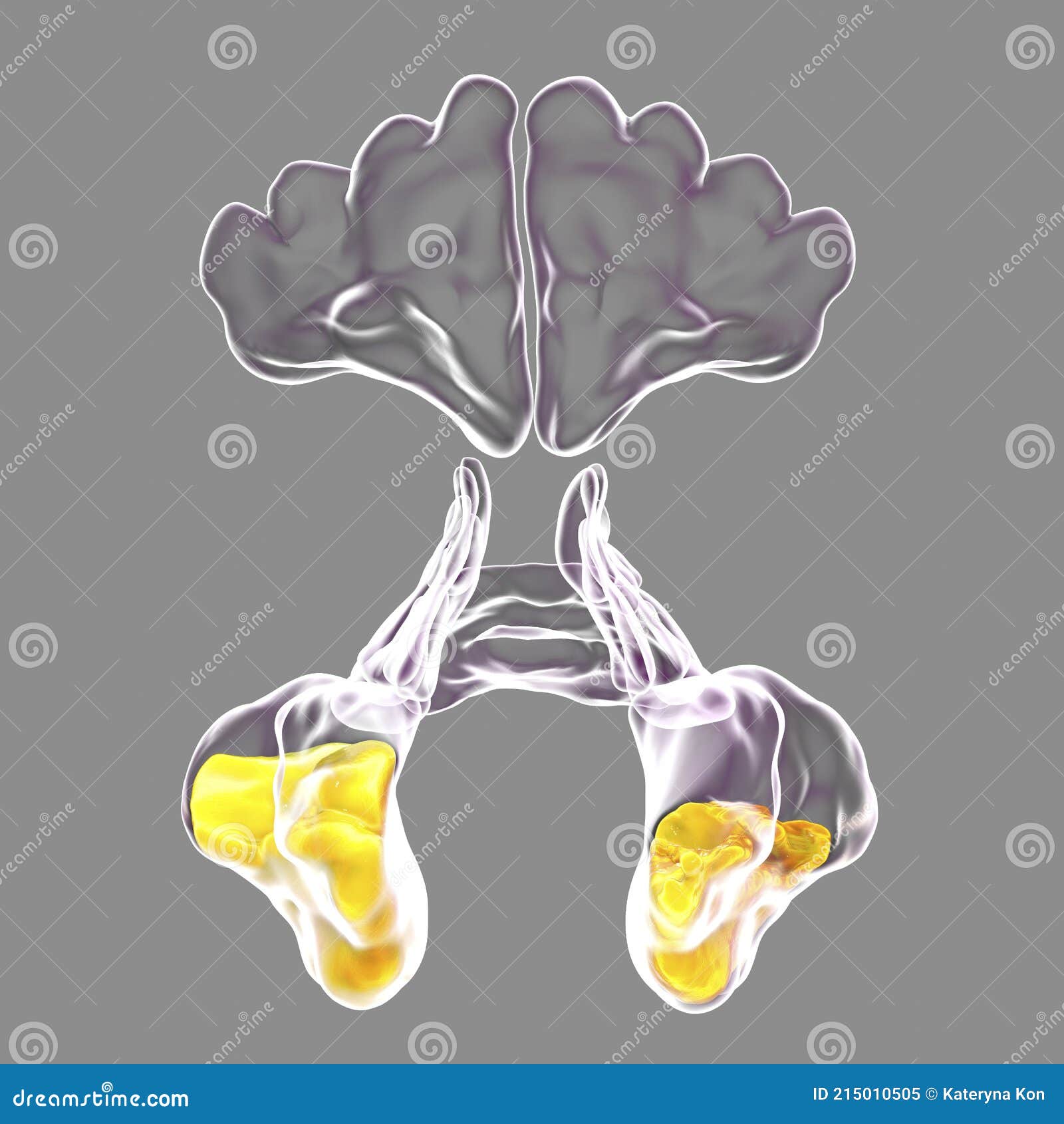 Inflammation of Maxillary Cavity, or Antrum of Highmore Stock ...