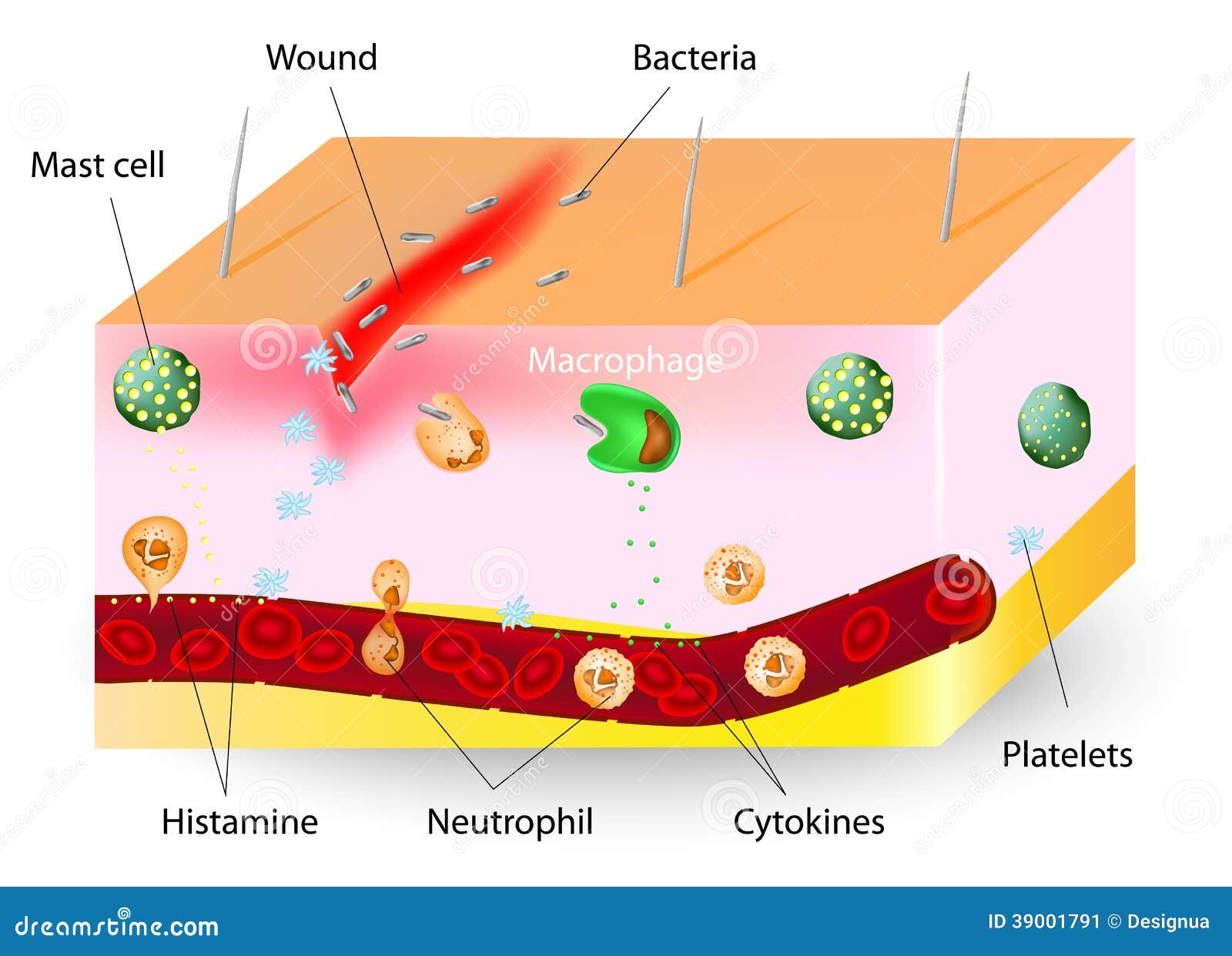 Inflammation. Medfödd Immunförsvar Vektor Illustrationer - Illustration ...