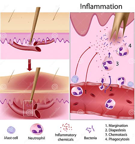 Inflammation response stock vector. Illustration of histamine - 18958948