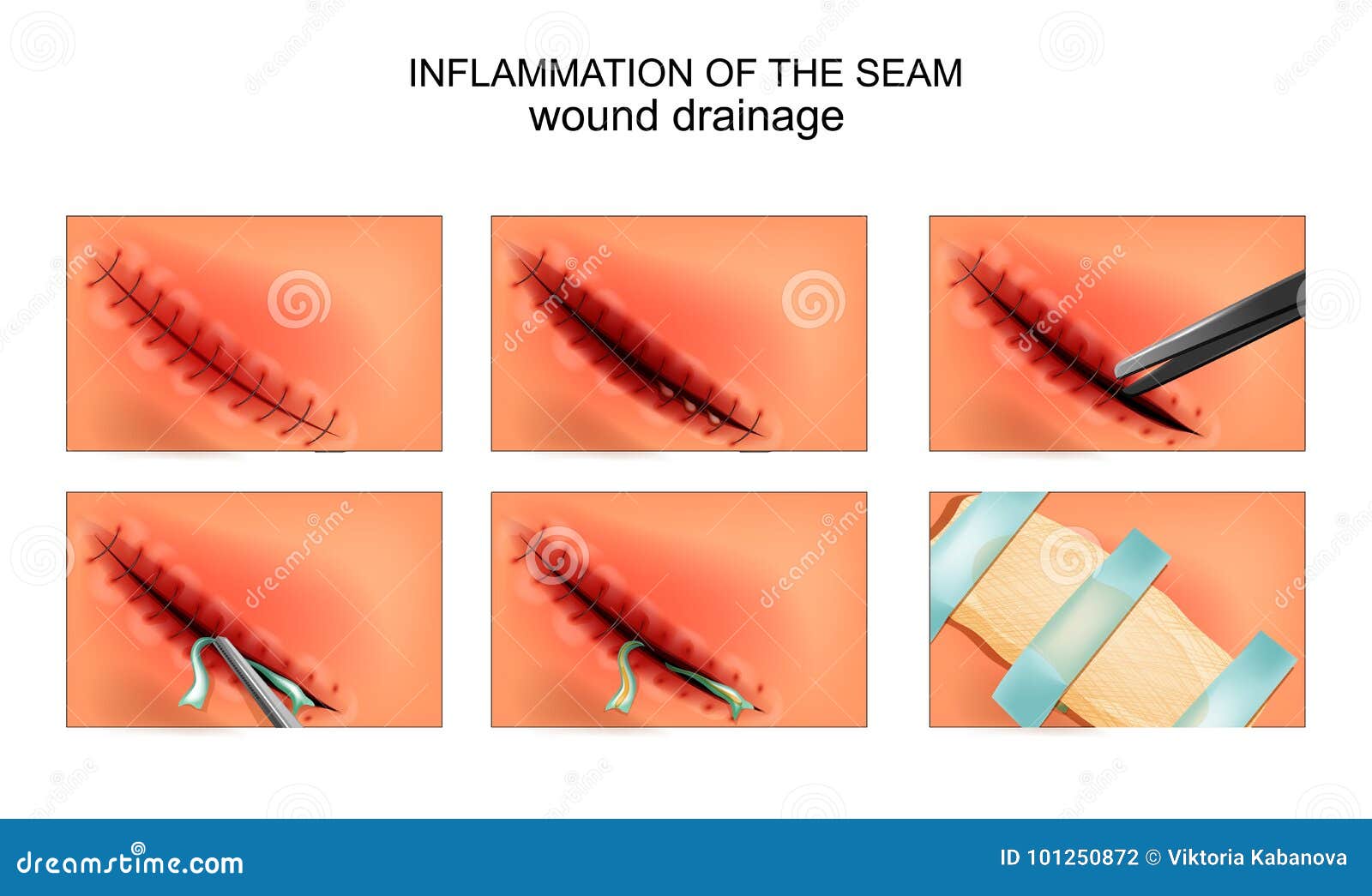 Inflammation Of The Surgical Site. Wound Drainage Vector Illustration ...