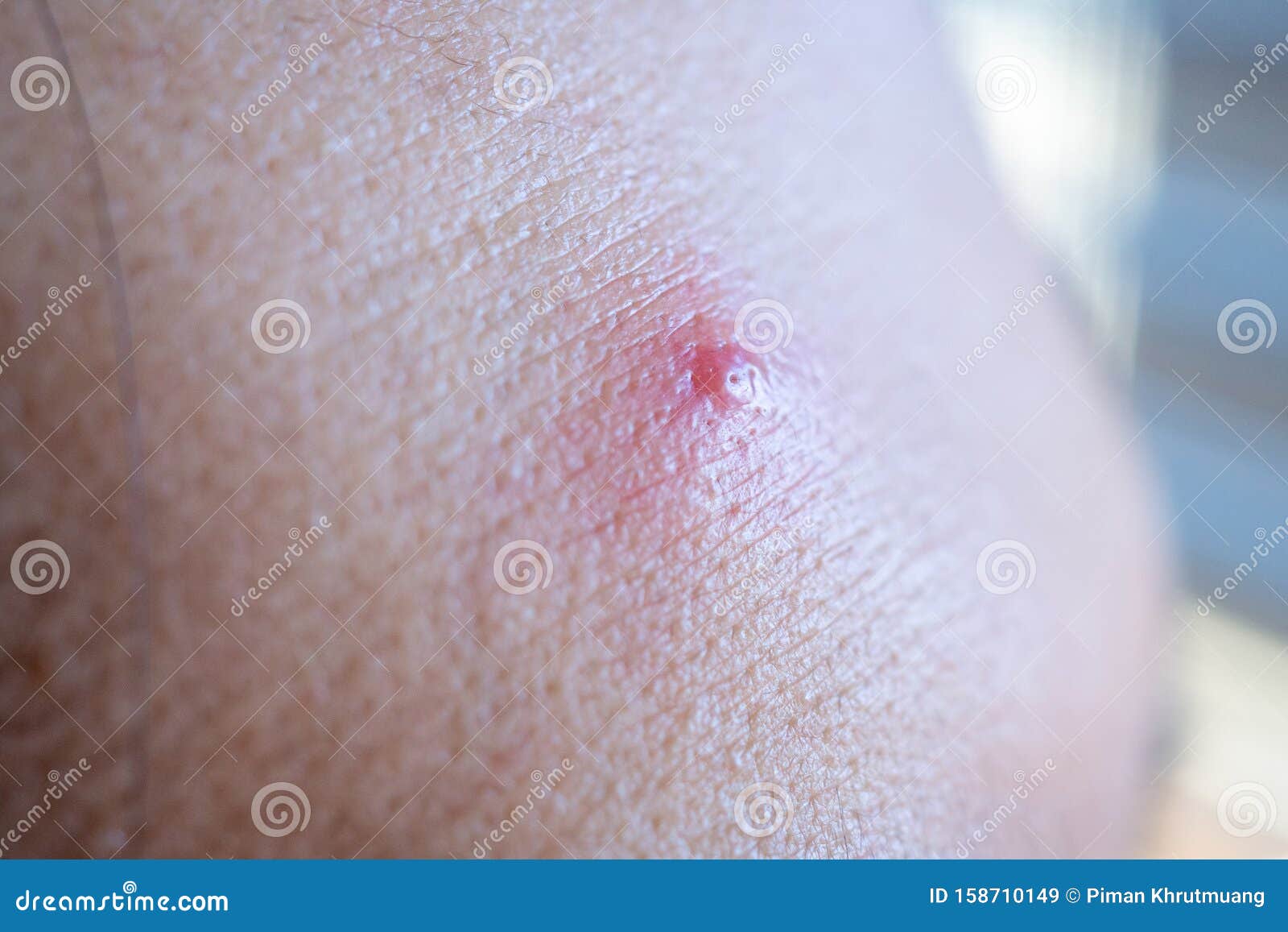 Inflammatory Acne with Red Spot on Face Closeup Stock Image - Image of ...