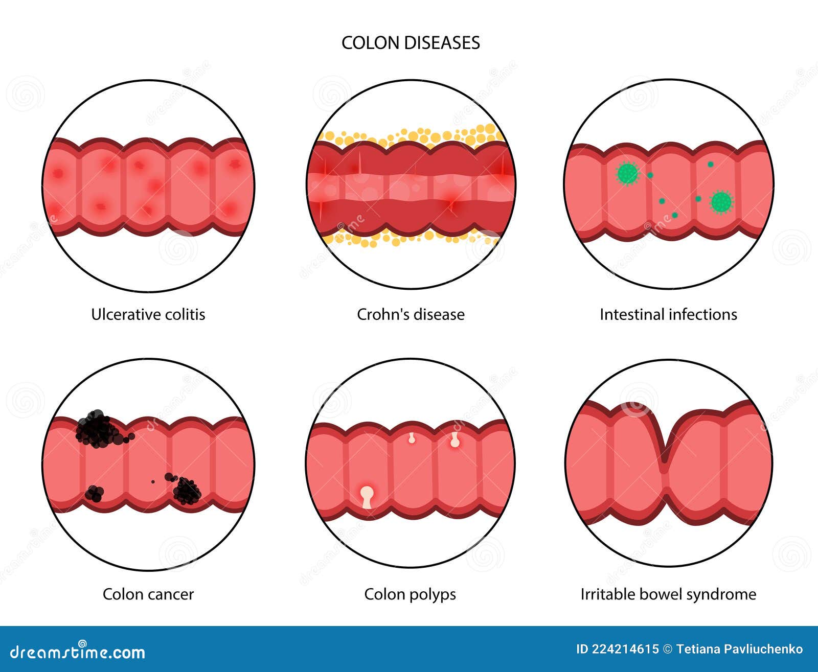 Intestines Diseases Concept Stock Vector - Illustration of syndrome ... Intestines Diseases Concept Stock Vector - Illustration of syndrome ...