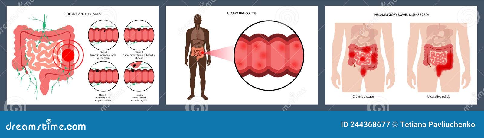 Intestines Diseases Concept Stock Vector - Illustration of irritable ... Intestines Diseases Concept Stock Vector - Illustration of irritable ...