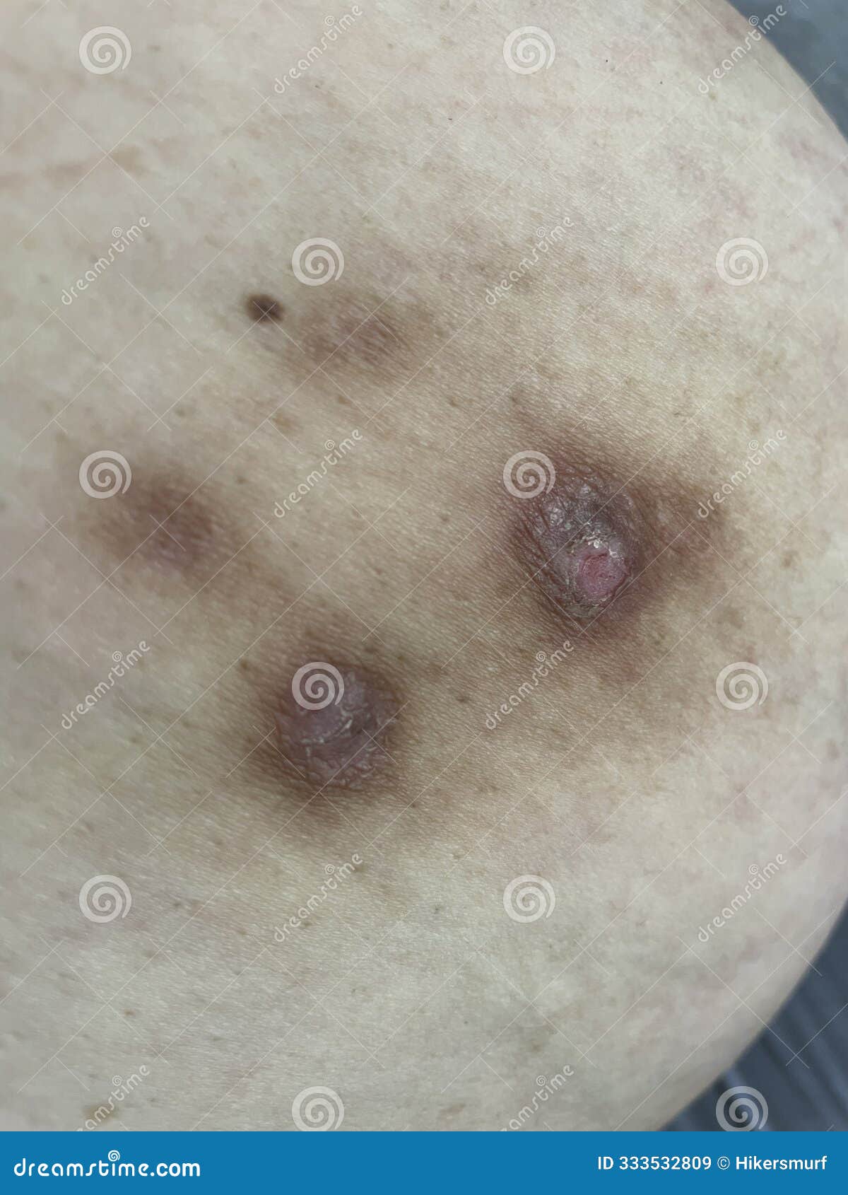 Inflammatory Changes Pustules, Rash on the Skin Stock Image - Image of ...