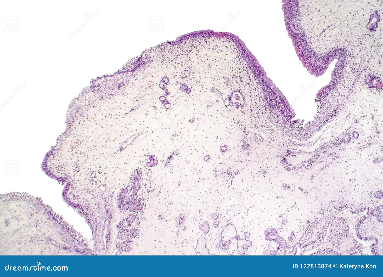 Inflammatory Polyp, Light Micrograph Stock Photo - Image of hematoxylin ...