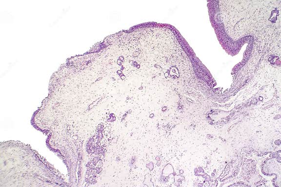 Inflammatory Polyp, Light Micrograph Stock Photo - Image of hematoxylin ...