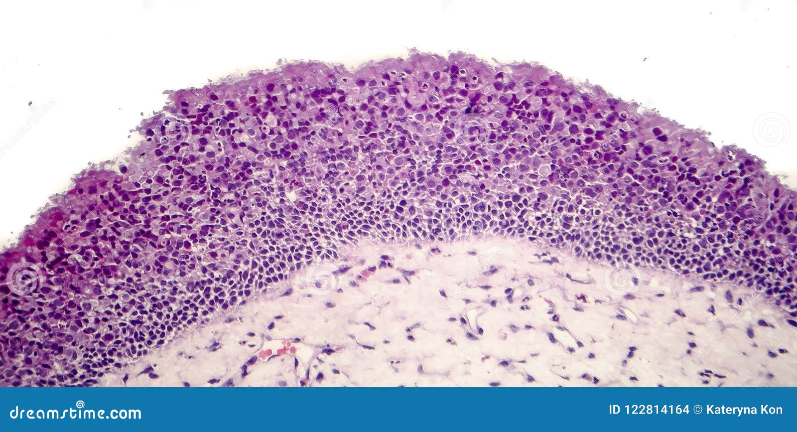 Inflammatory Polyp, Light Micrograph Stock Photo - Image of ...