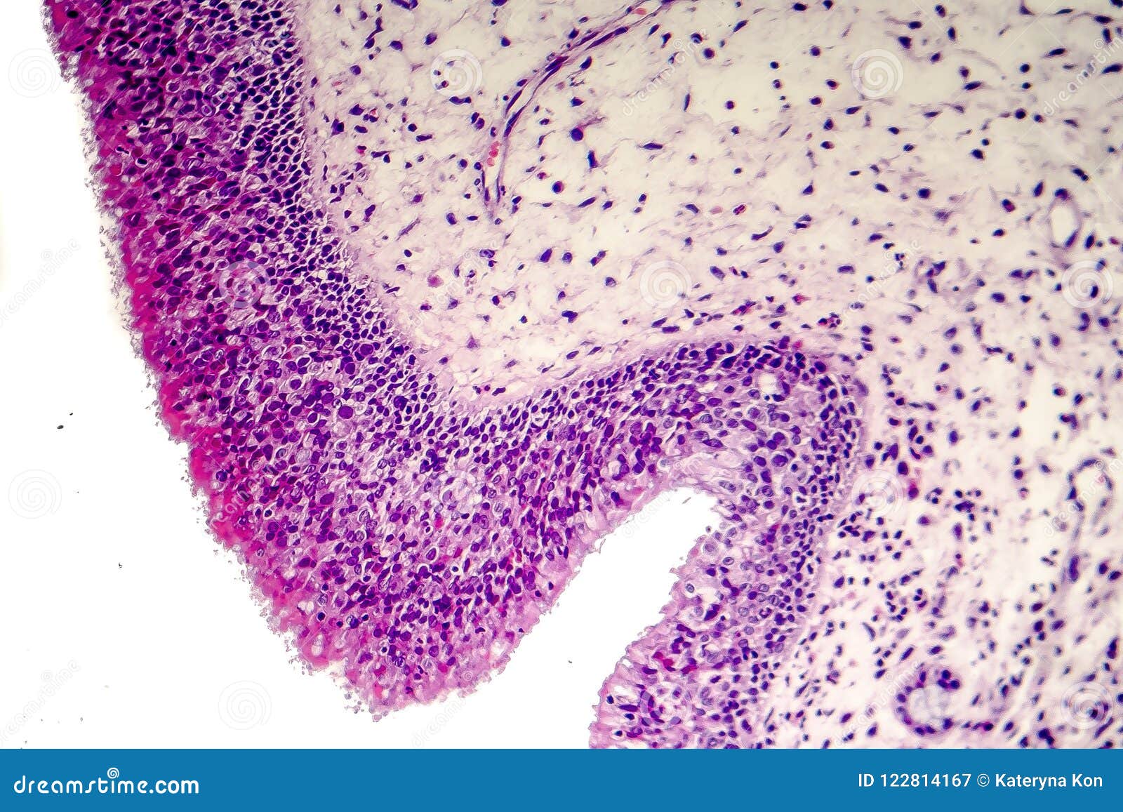 Inflammatory Polyp, Light Micrograph Stock Image - Image of ...