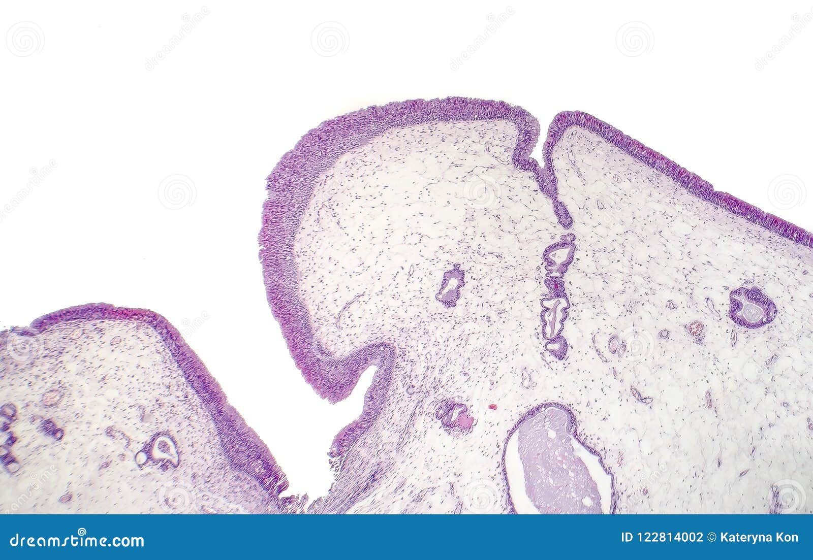 Inflammatory Polyp, Light Micrograph Stock Photo - Image of ...