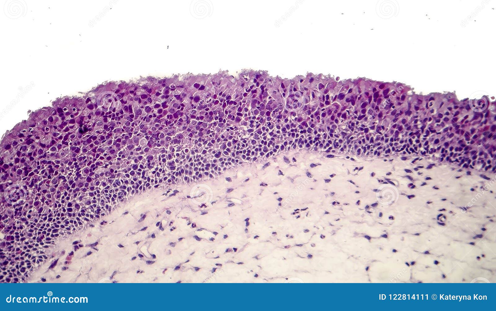 Inflammatory Polyp, Light Micrograph Stock Image - Image of cell ...