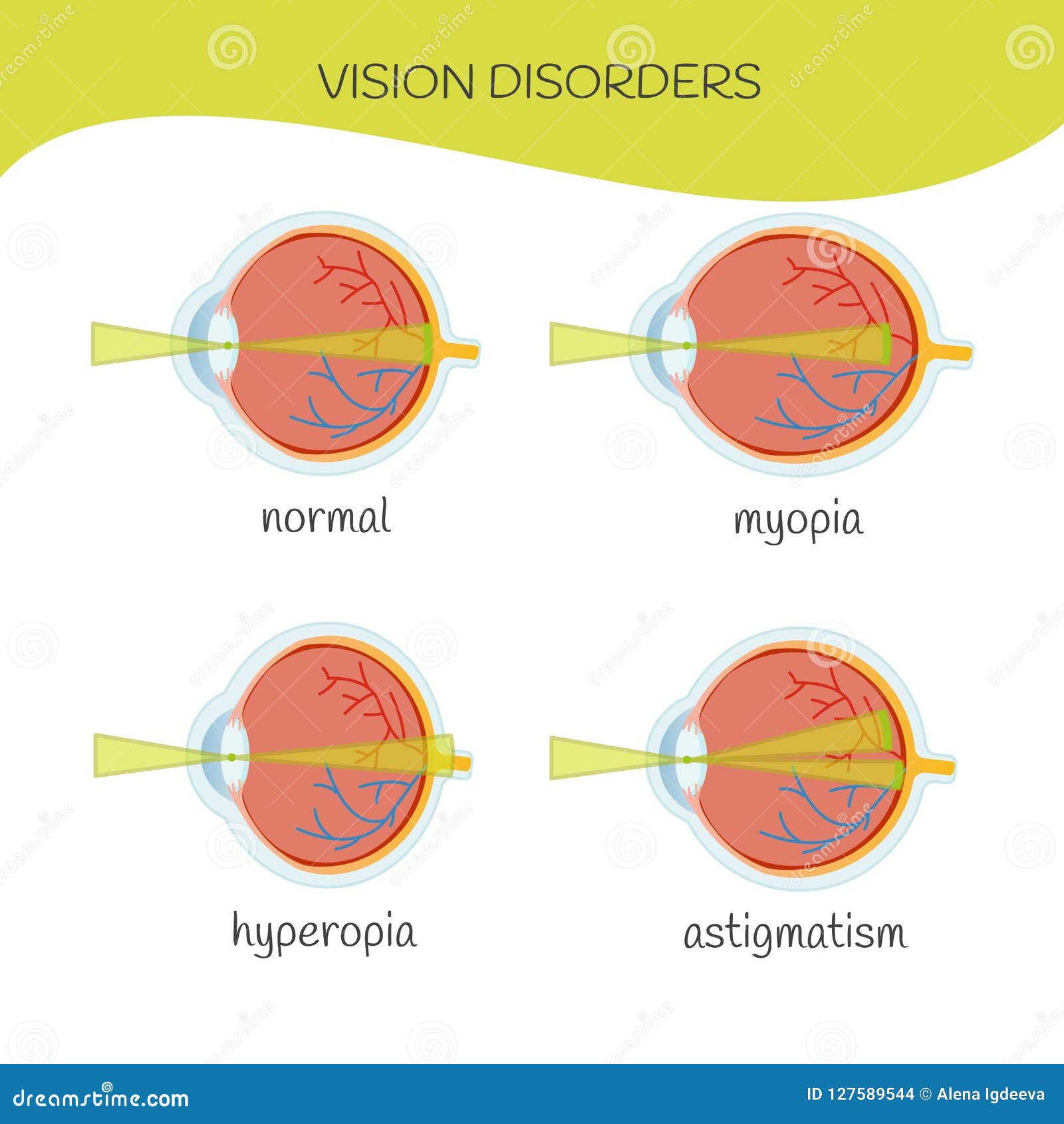 Infografica eyes disease stock vector. Illustration of glasses - 127589544