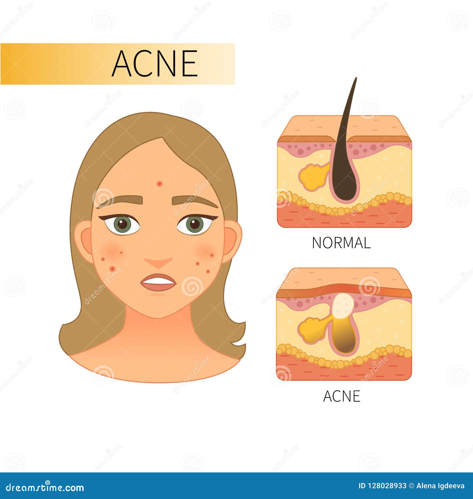Infographic av akne vektor illustrationer. Illustration av ...