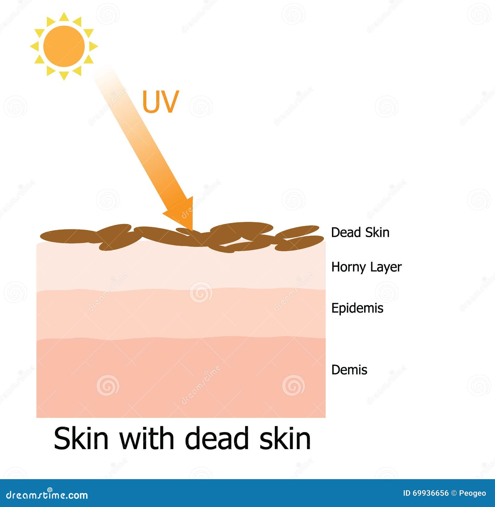 Infographic about Dead Skin Stock Illustration - Illustration of rays ...
