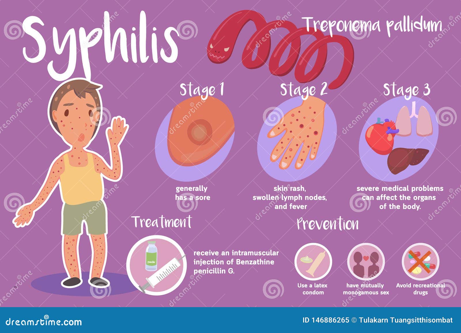 Infographic du syphilis illustration de vecteur. Illustration du latent ...