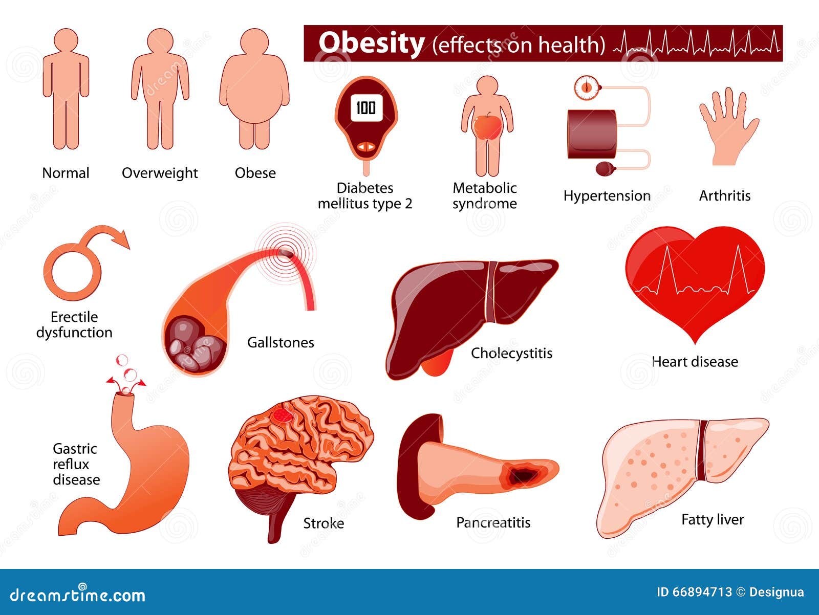 Infographic Fetma Och övervikt Vektor Illustrationer - Illustration av ...