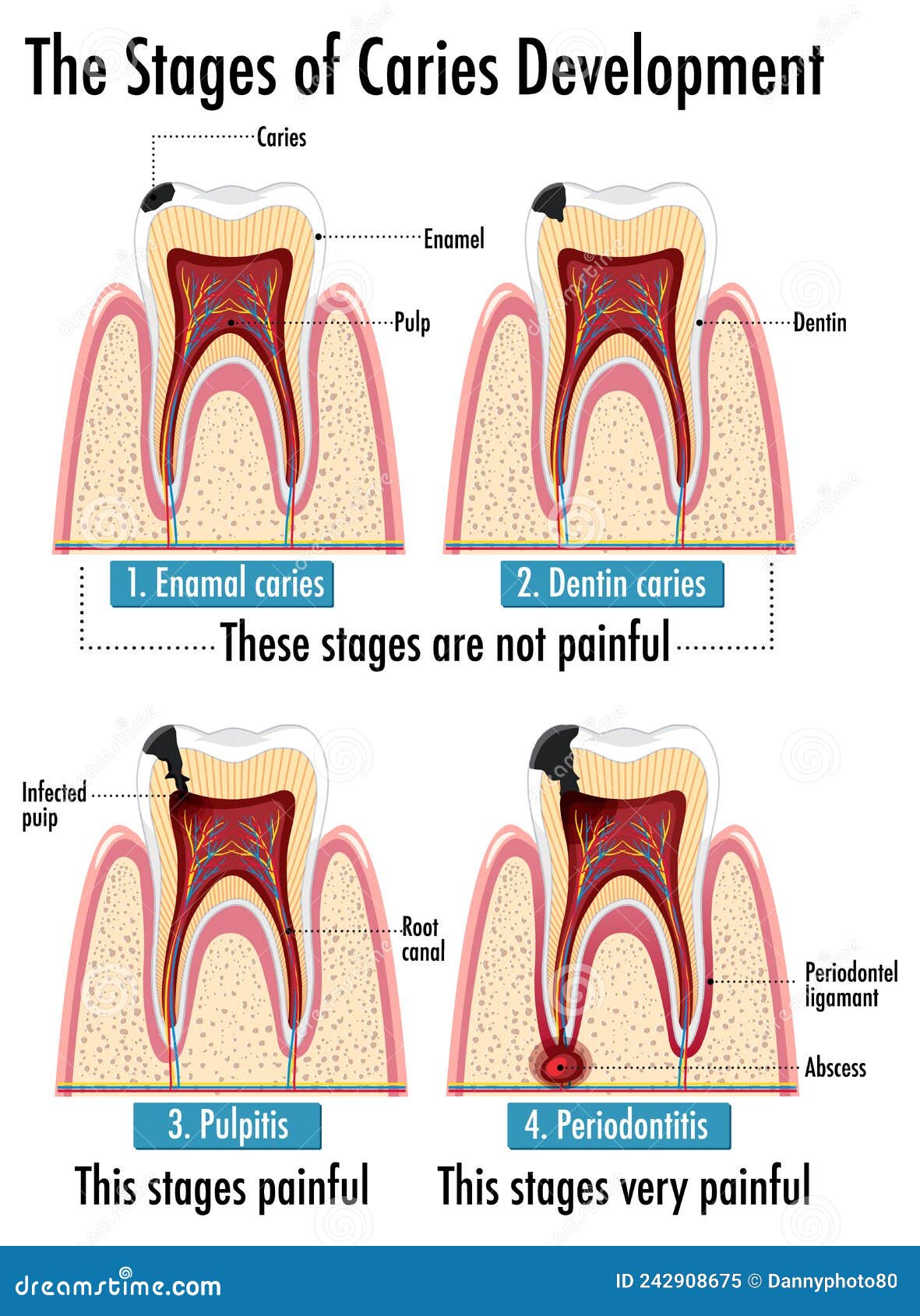 Infographic of Human in Stages of Caries Development Stock Vector ...