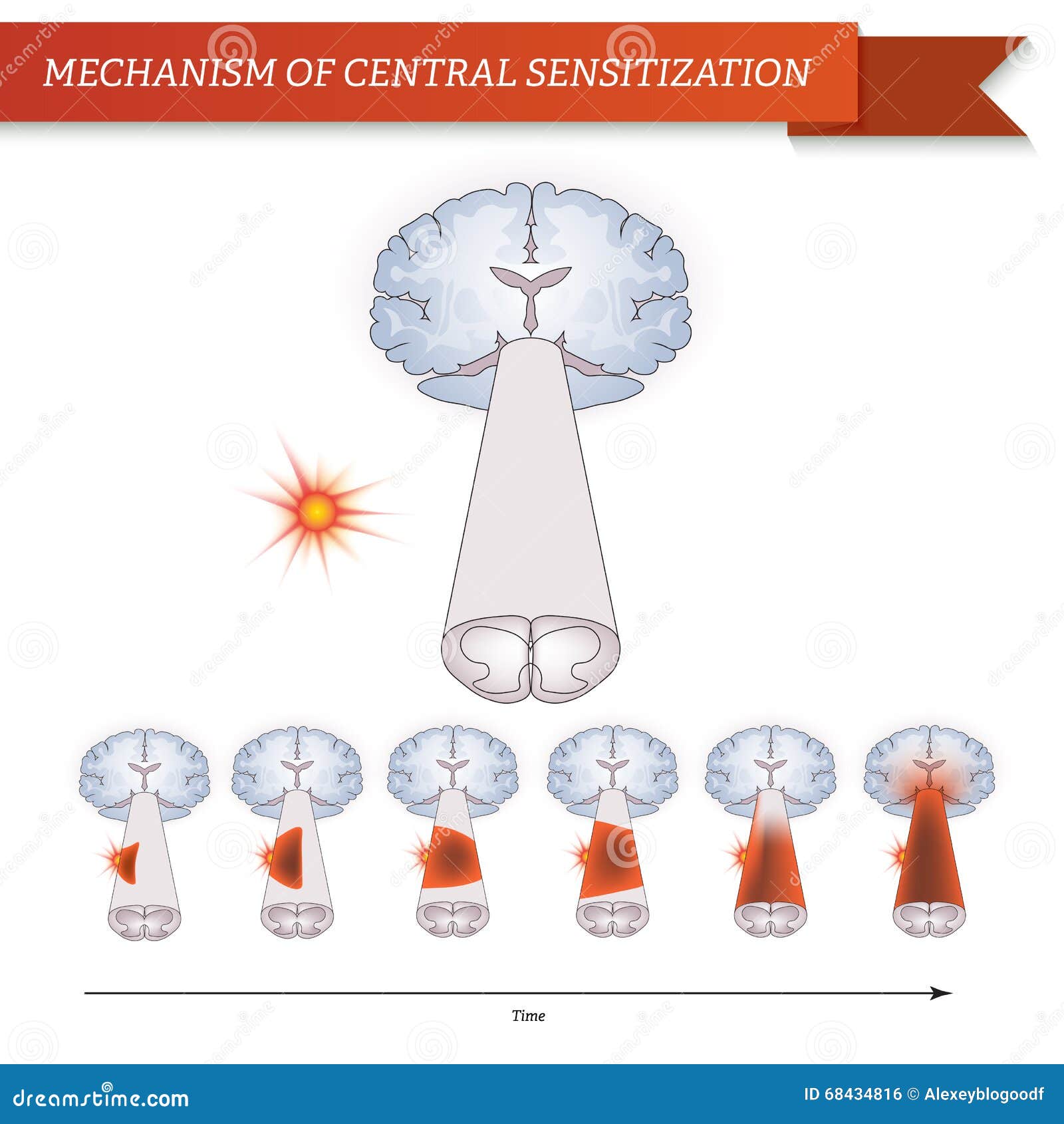 Infographic Mechanism of Central Sensitization. Stock Vector ...