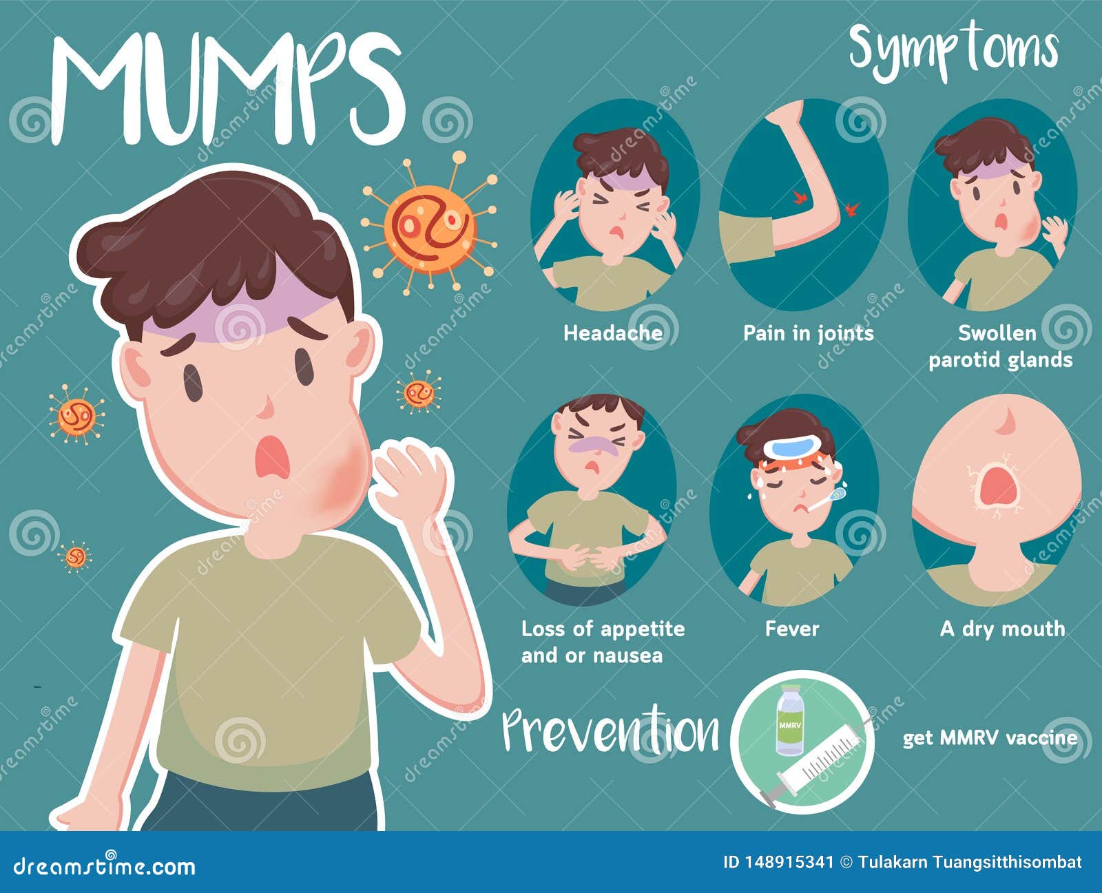 Infographic of Mumps stock vector. Illustration of mumps - 148915341