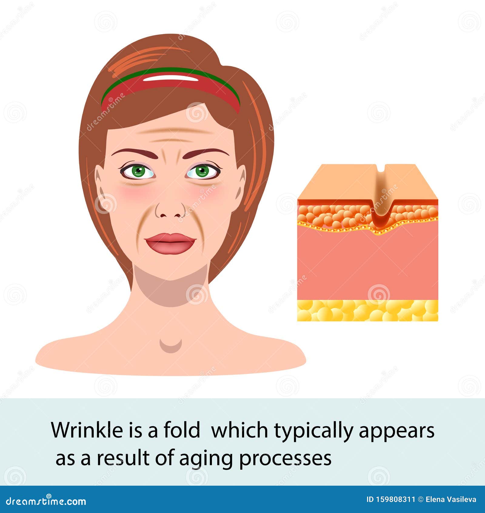 Infographic Skin Illustration. Wrinkle, Change of the Face, Vector ...