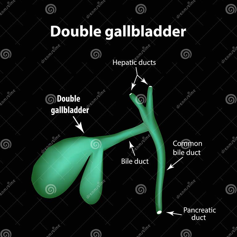 Double Gall Bladder. Pathology of the Gallbladder. Cholecystitis. the ...