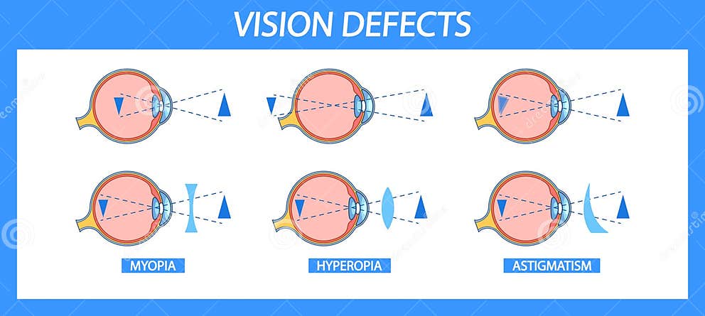 Informative Chart Detailing Myopia, Hyperopia, and Astigmatism in Eye ...