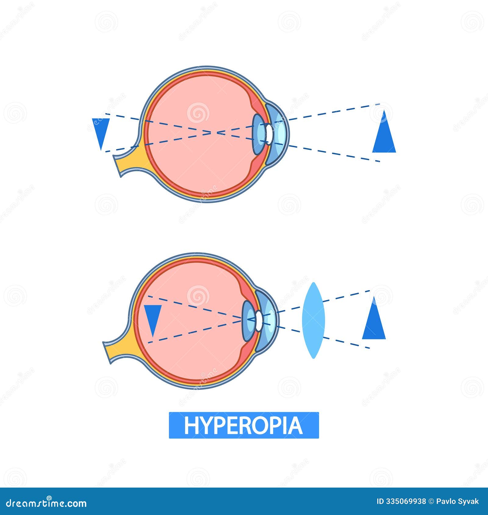 Informative Vector Infographic Depicting Hyperopia, Illustrating the ...