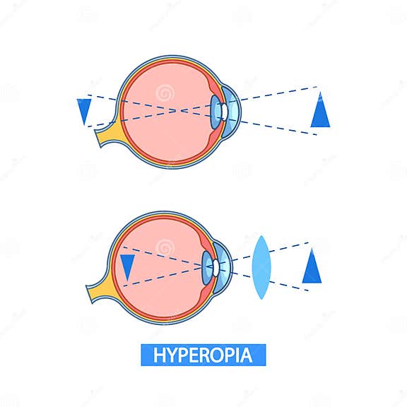 Informative Vector Infographic Depicting Hyperopia, Illustrating the ...