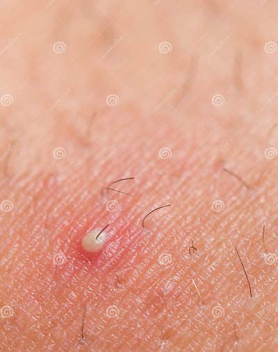 Ingrown hair stock photo. Image of furuncle, explode - 29102470