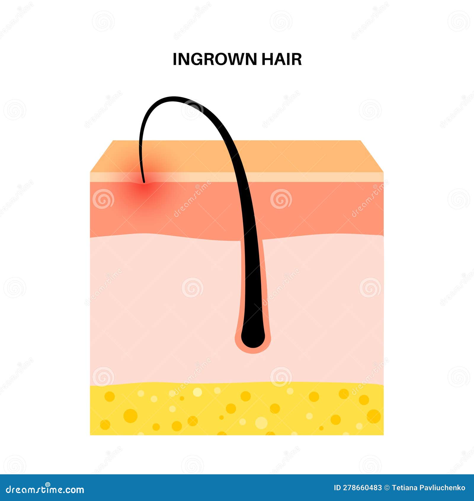Ingrown Hair Medical Scheme Under Microscope Cartoon Vector 286346169