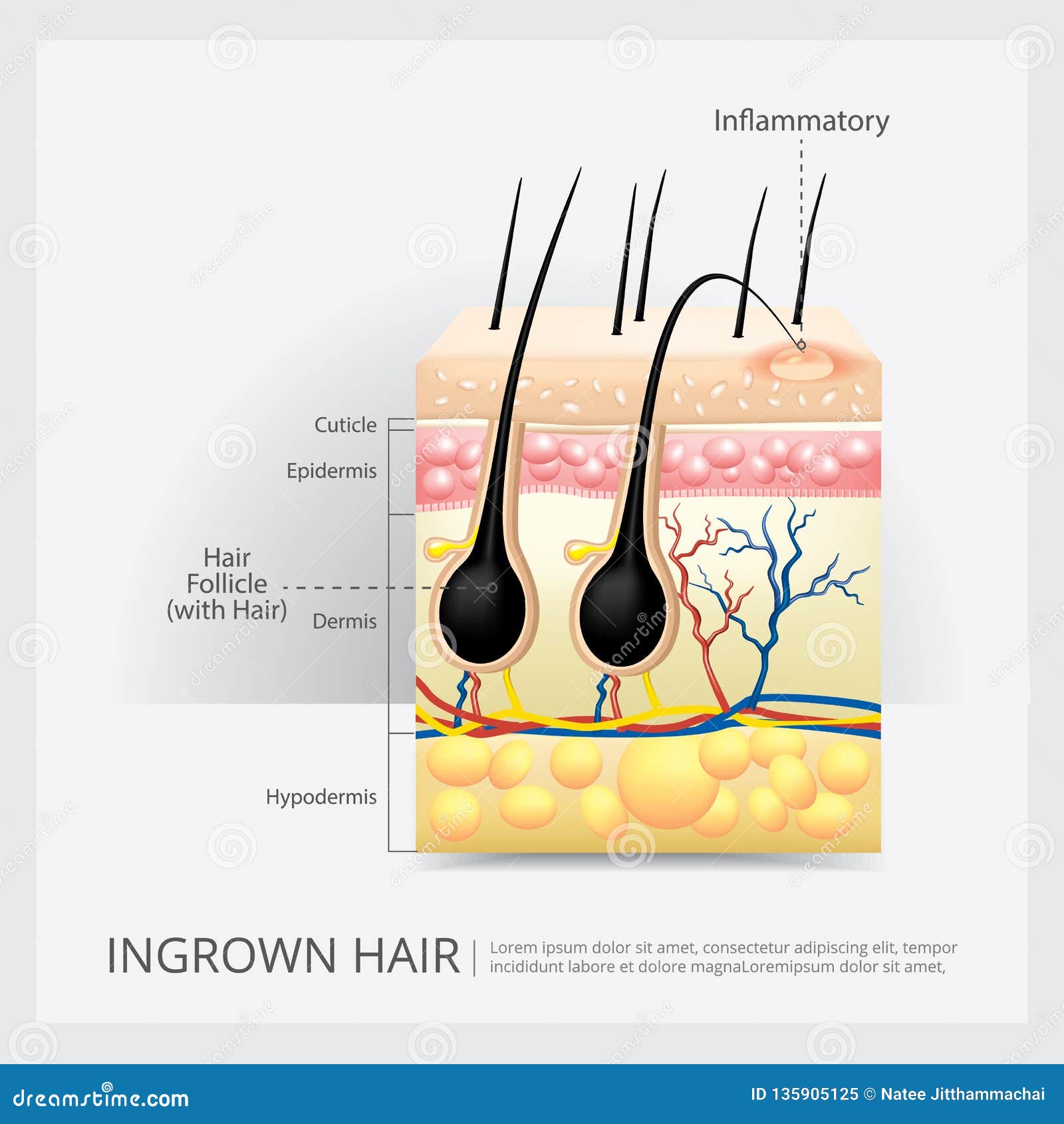 Ingrown Hair Structure Cartoon Vector | CartoonDealer.com #137649043