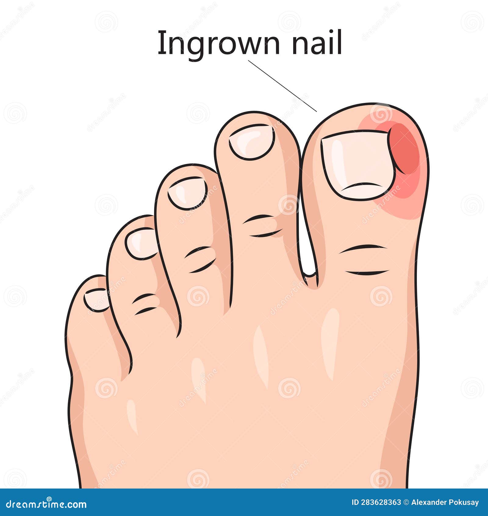 Ingrown Nail Diagram
