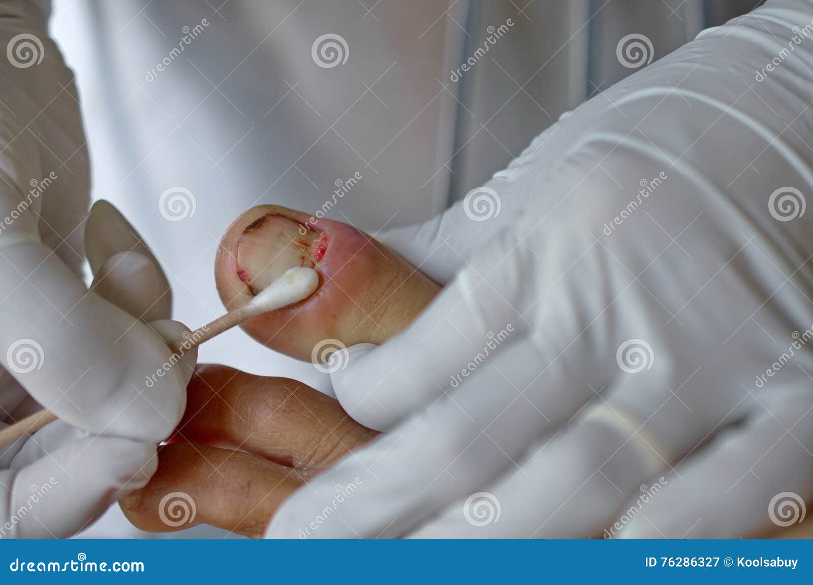 Ingrown nail wound. stock image. Image of medicine, treatment - 76286327