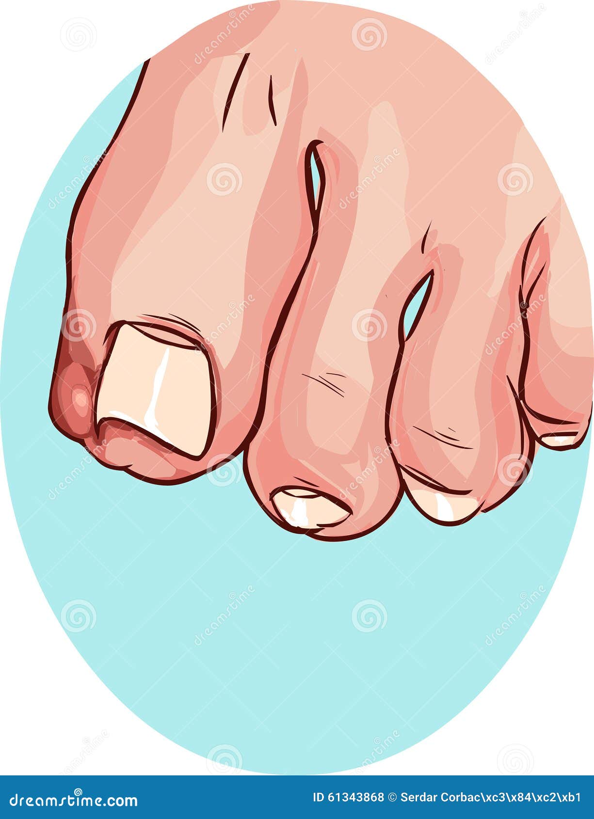 Ingrown toenail иллюстрация вектора. иллюстрации насчитывающей ноготь ...