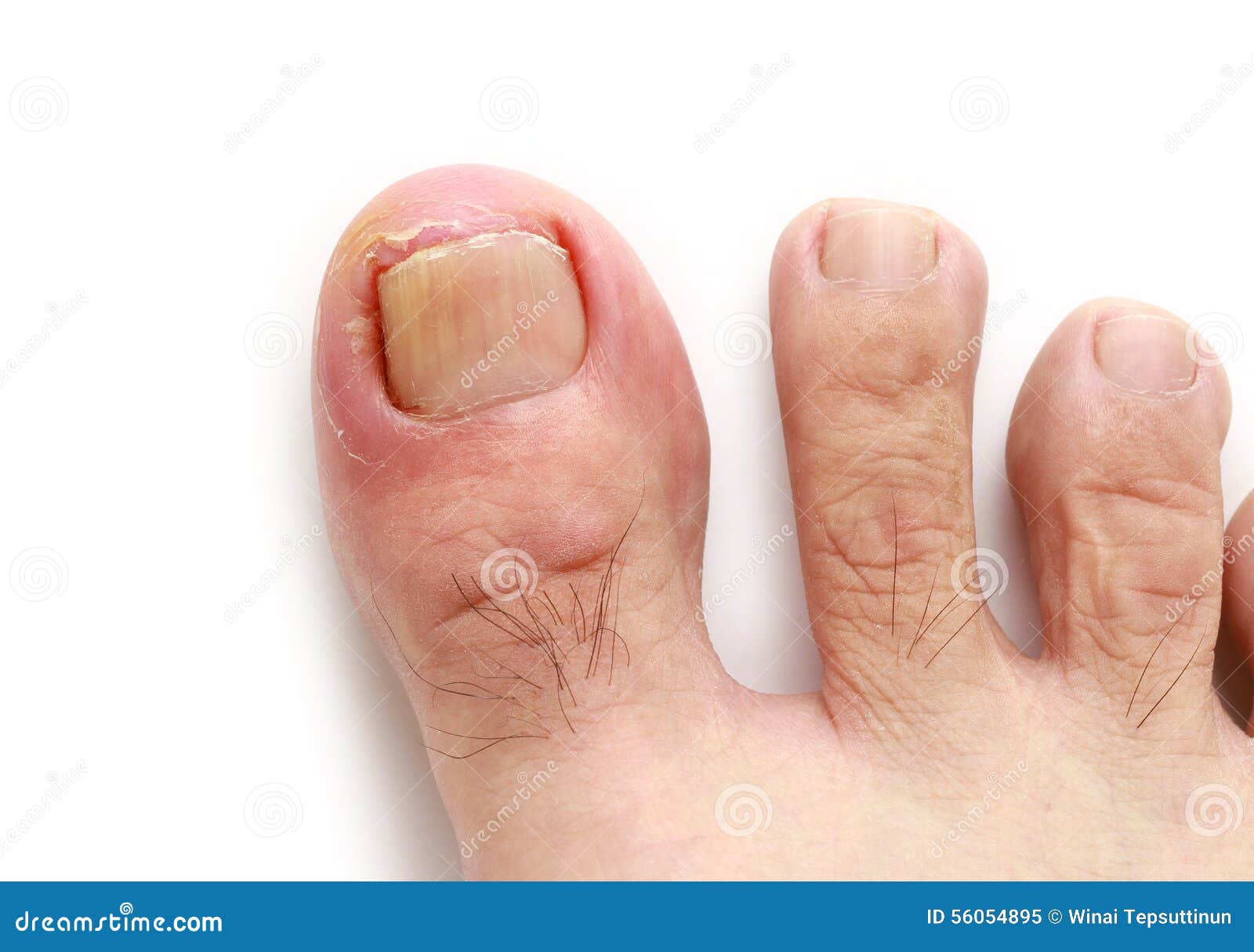 Ingrown Toenail Onychocryptosis On Caucasian Big Toe Hallux, Caused By ...